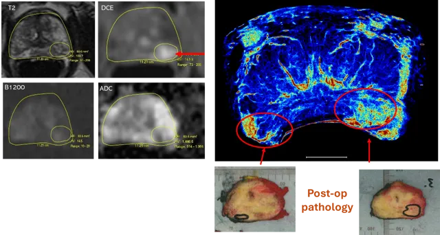 New ultrasound imaging technique reliably spots prostate cancer ...